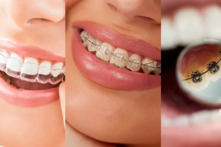 Verschillende soorten beugels: welke is geschikt voor jou?